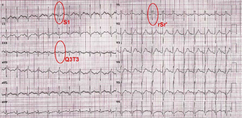 EKG 010 – EKG değerlendirmede 8 adımlı kontrol listesi algoritmasına ...